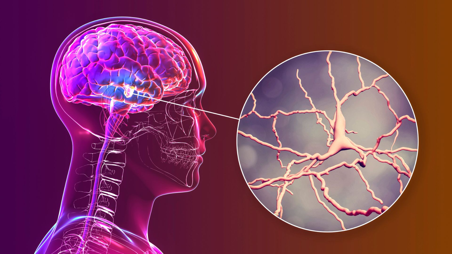 Lab-grown nerve cells to replace those destroyed by Parkinson's in ...