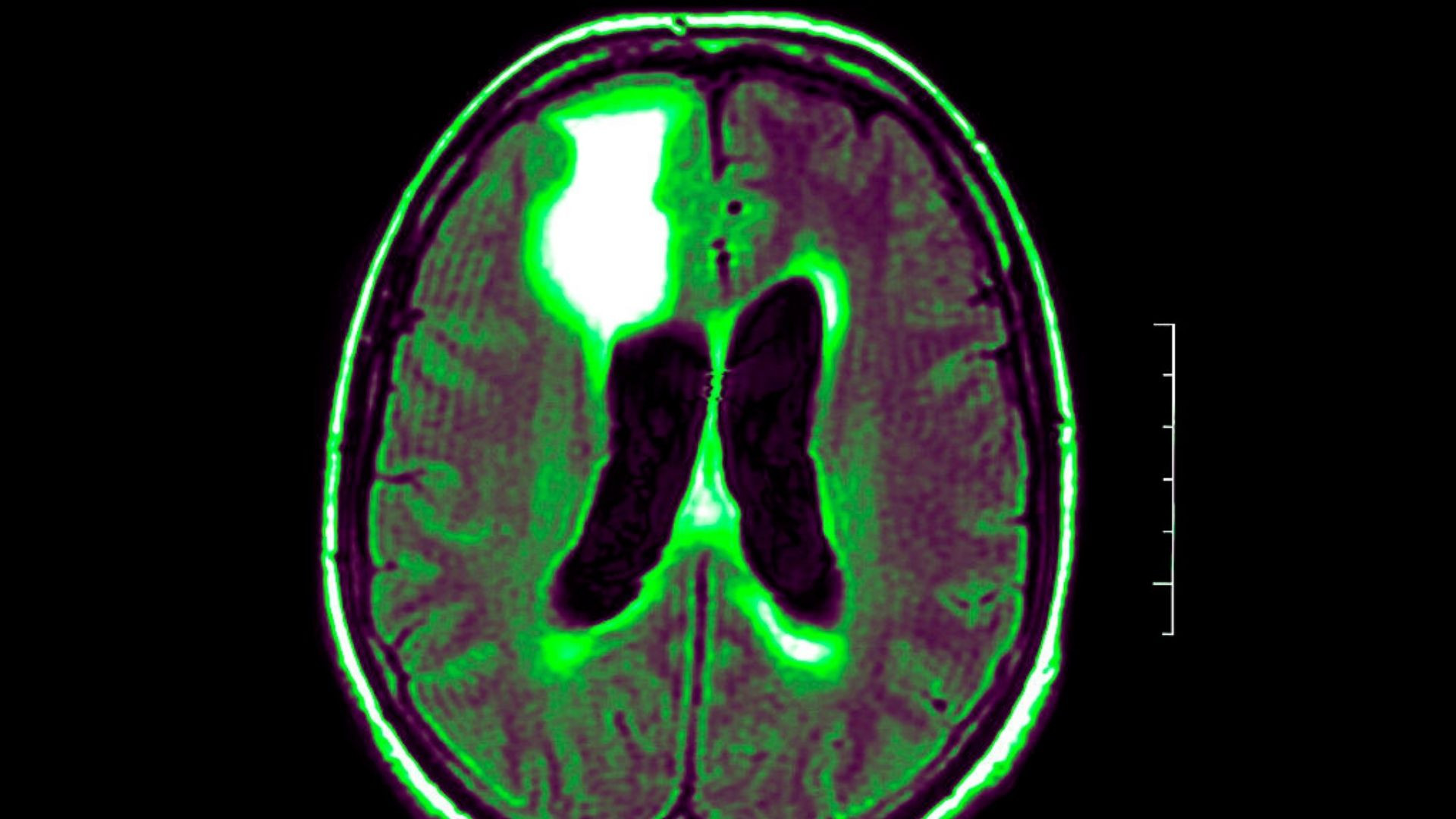 Laser light therapy could be the key to improving short-term memory