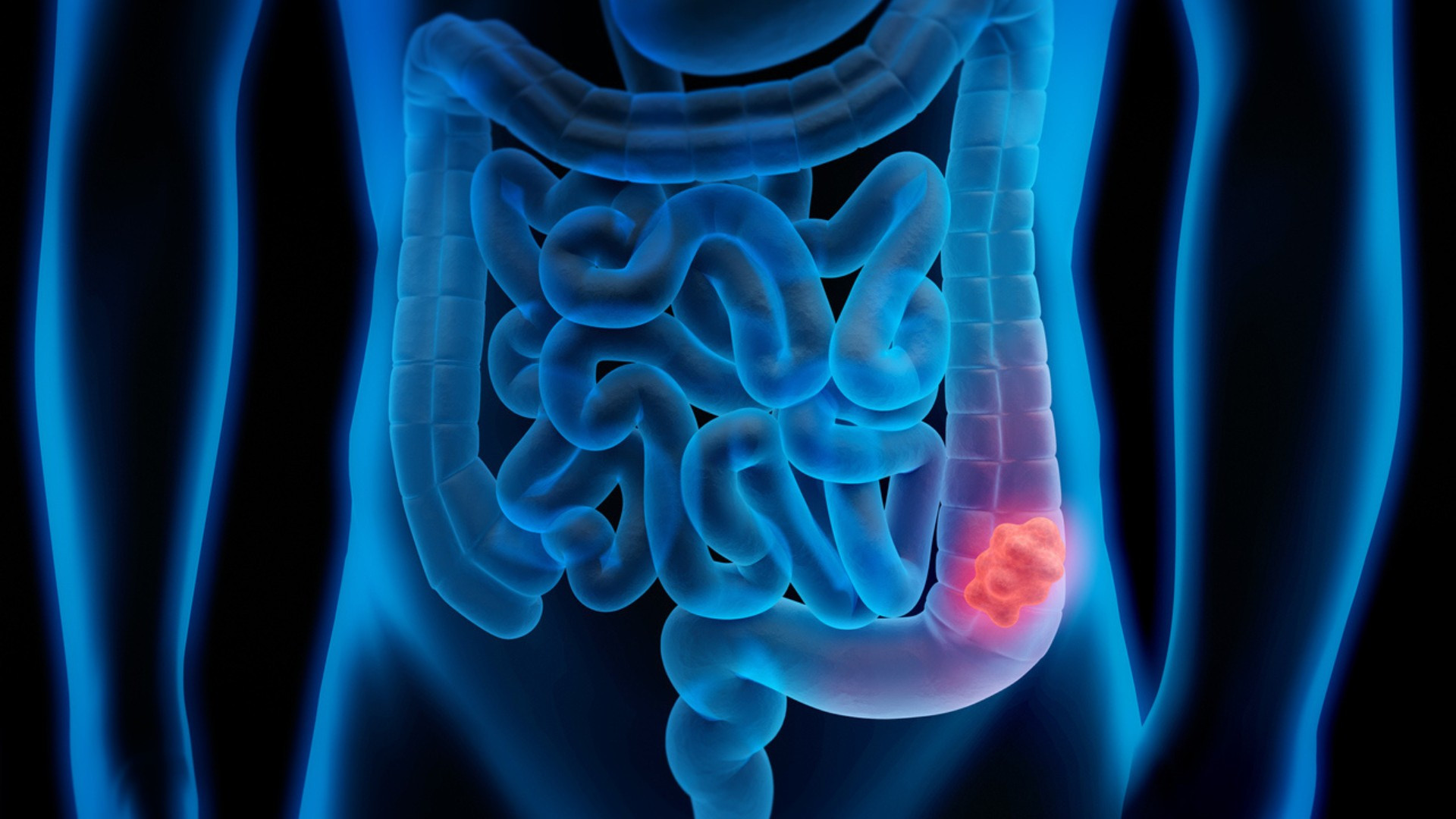 Colon cancer on the rise among young Americans, early detection is key