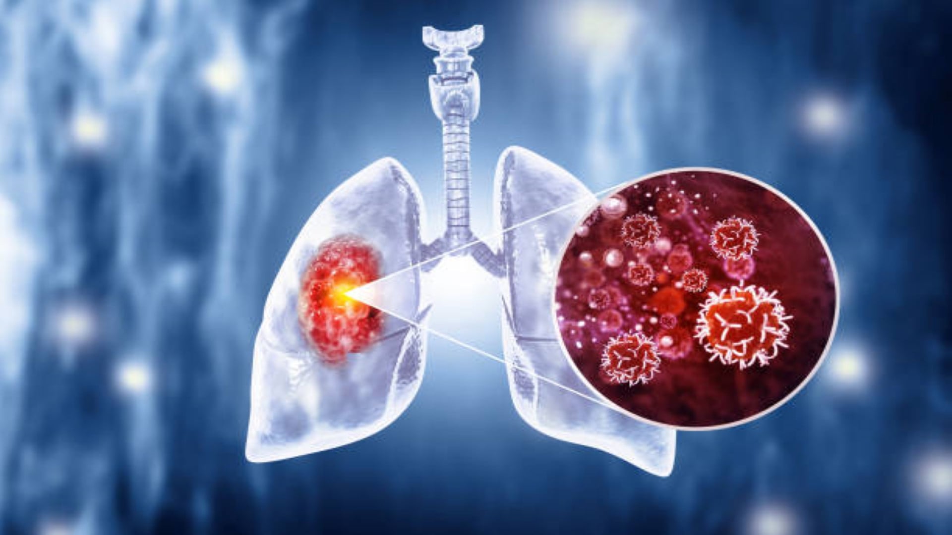 New AI-based tool shows promise in accurately identifying lung cancer