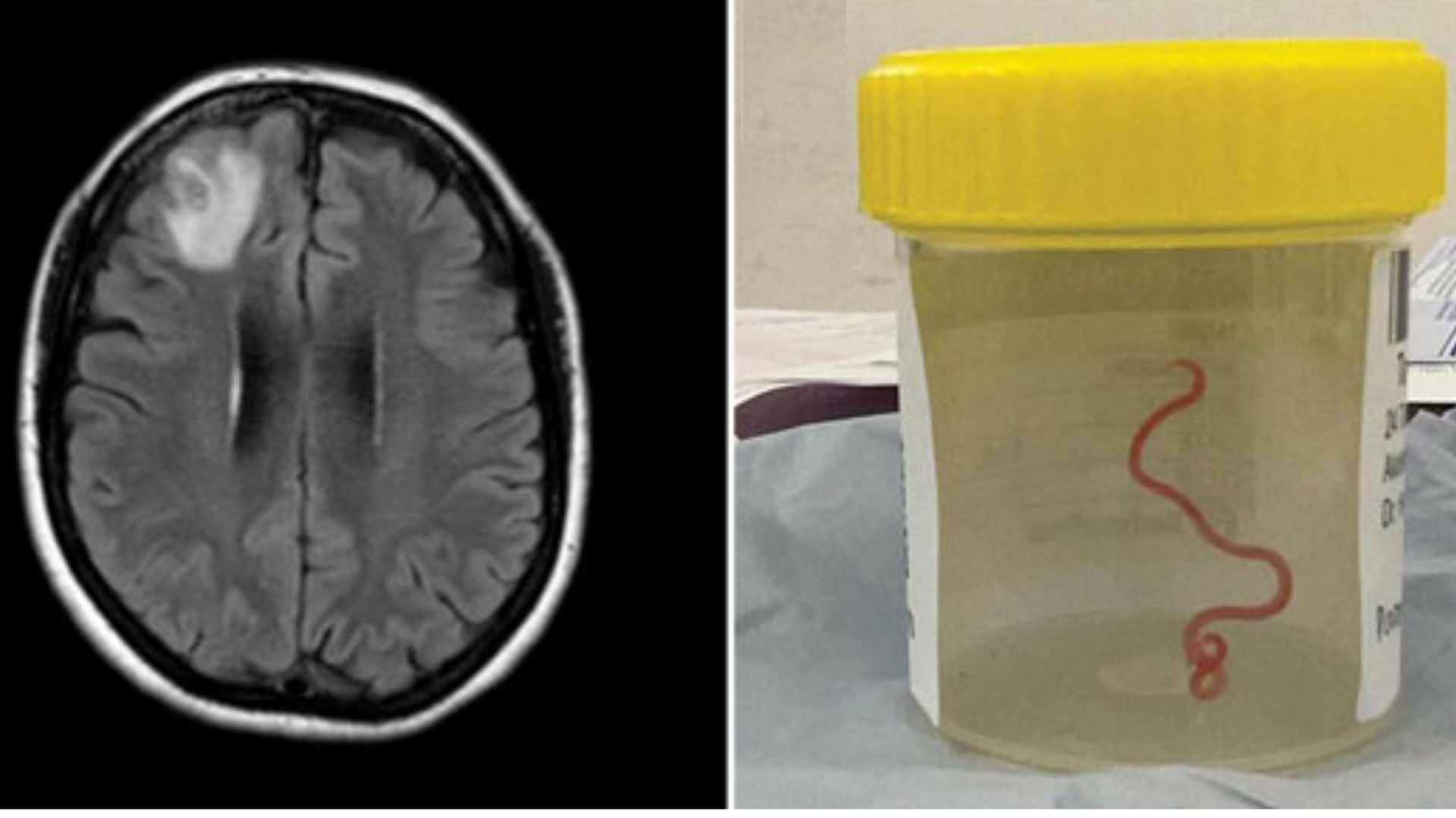 Doctors pull out a 3 inch live worm from woman's brain