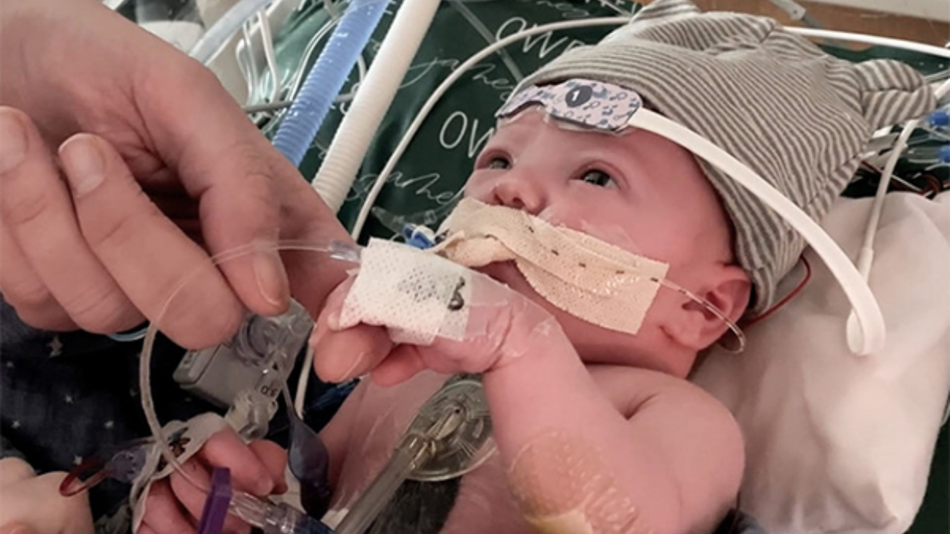 World's first partial heart transplant raises hope for kids