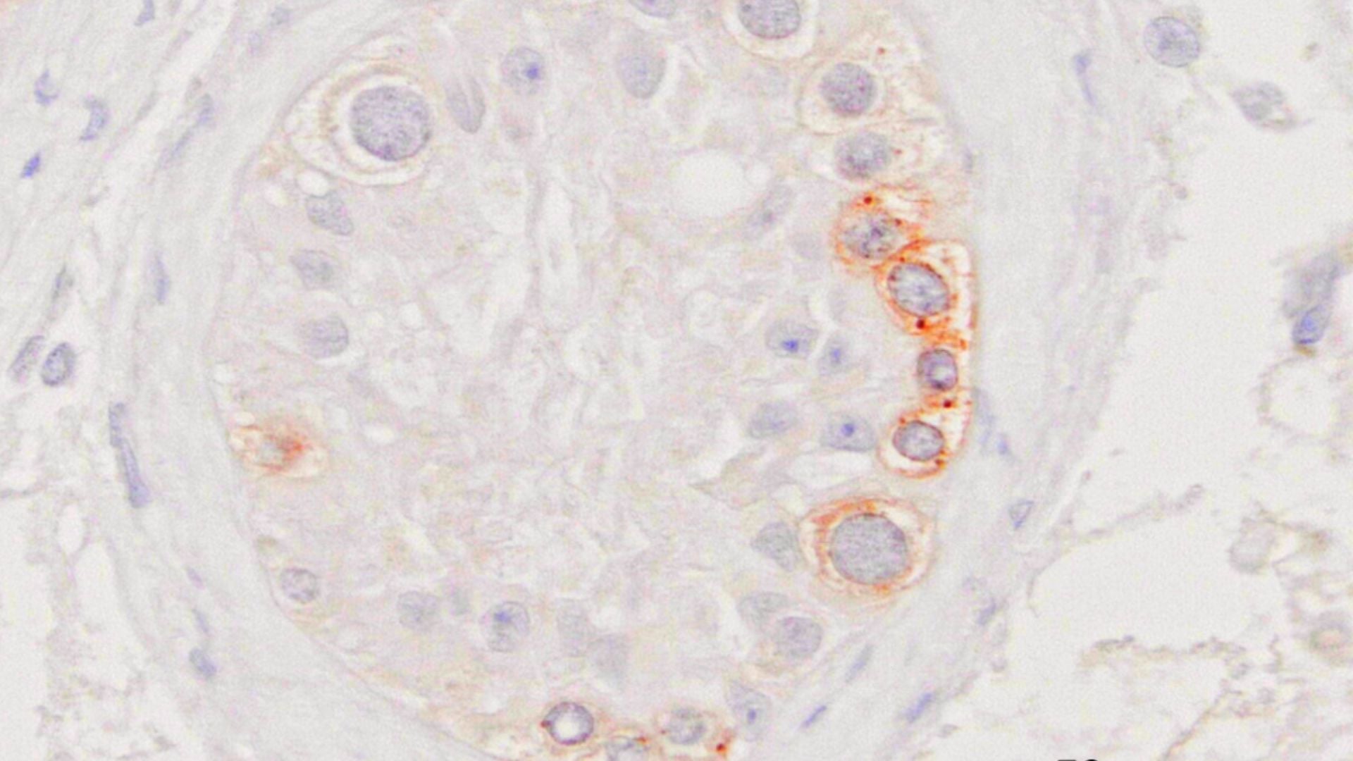 Unlocking male fertility: Gene discovery paves way for new treatment