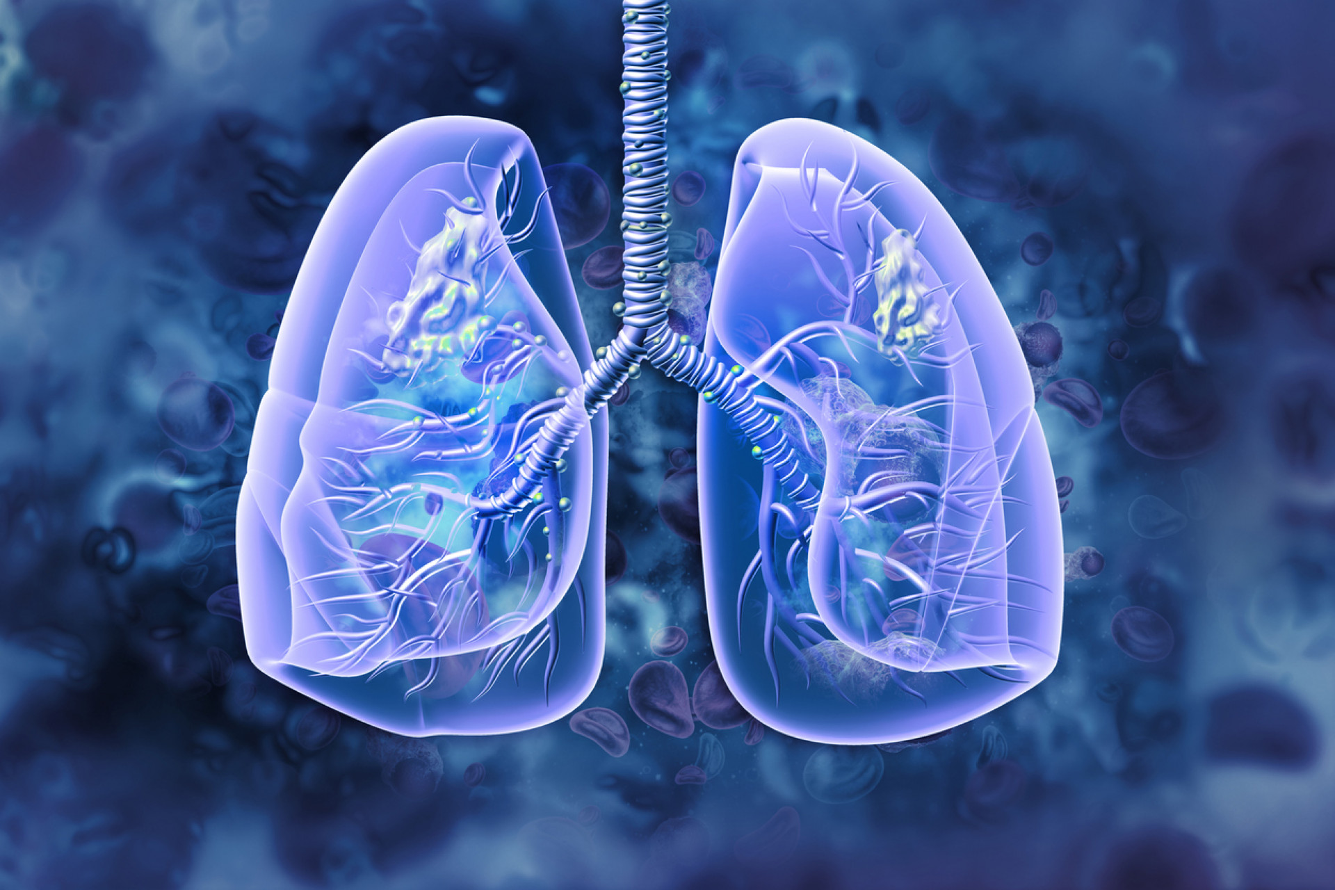 Inhalable Therapy Shows Promise In Treating Lung Cancer