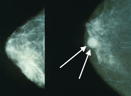 Groundbreaking Treatment Cures Woman's Advanced Breast Cancer in World ...