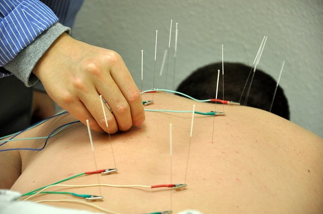 New Study Suggests Acupuncture Can Remap the Brain to Relieve Chronic Pain