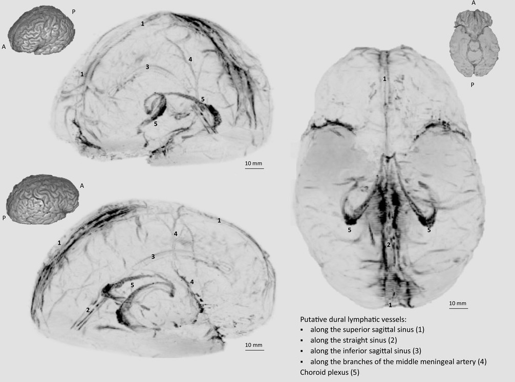 The Link Between Our Brain and Lymphatic System Could Help Scientists ...