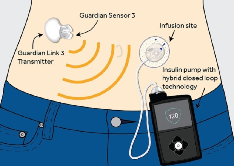 World's First 'Artificial Pancreas' Just Approved