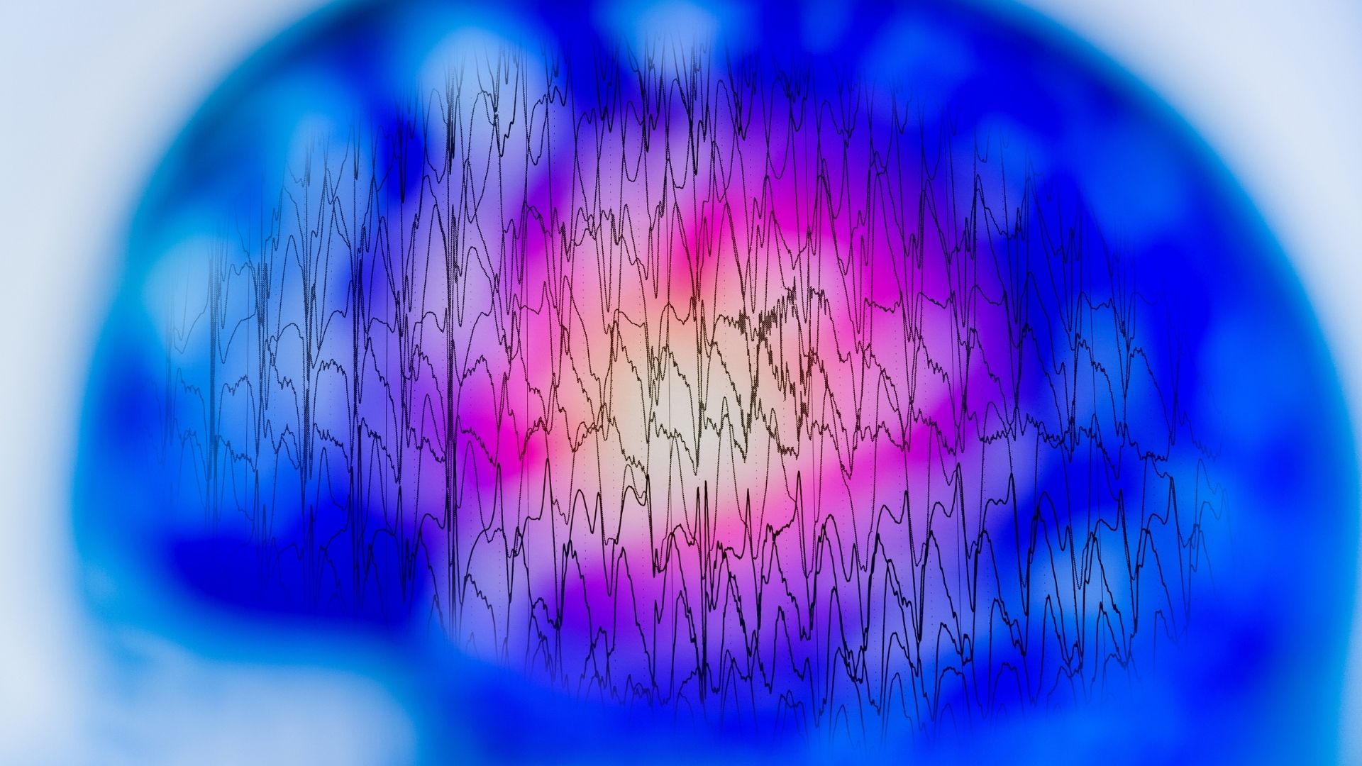 In a world-first, researchers record the brain waves of a dying patient