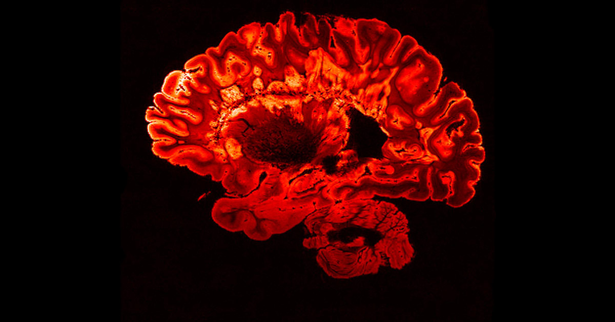 Scientists Hope to Develop Breath Test to Detect Multiple Sclerosis