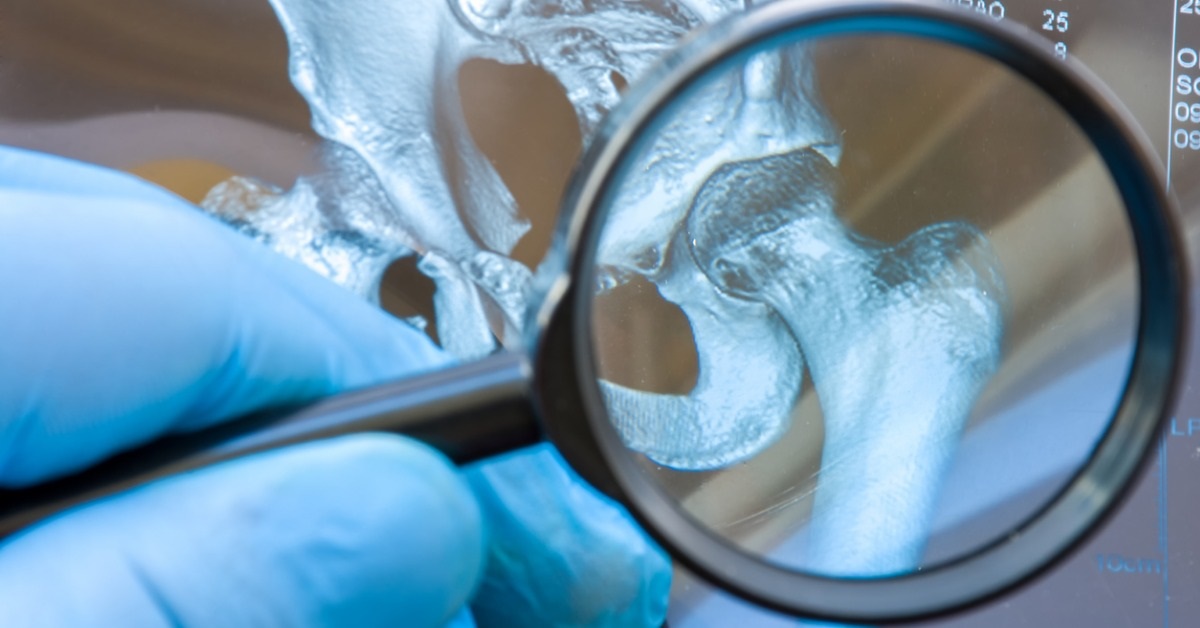 Material that Replicates Human Bone Tissue Developed By Oregon Researchers