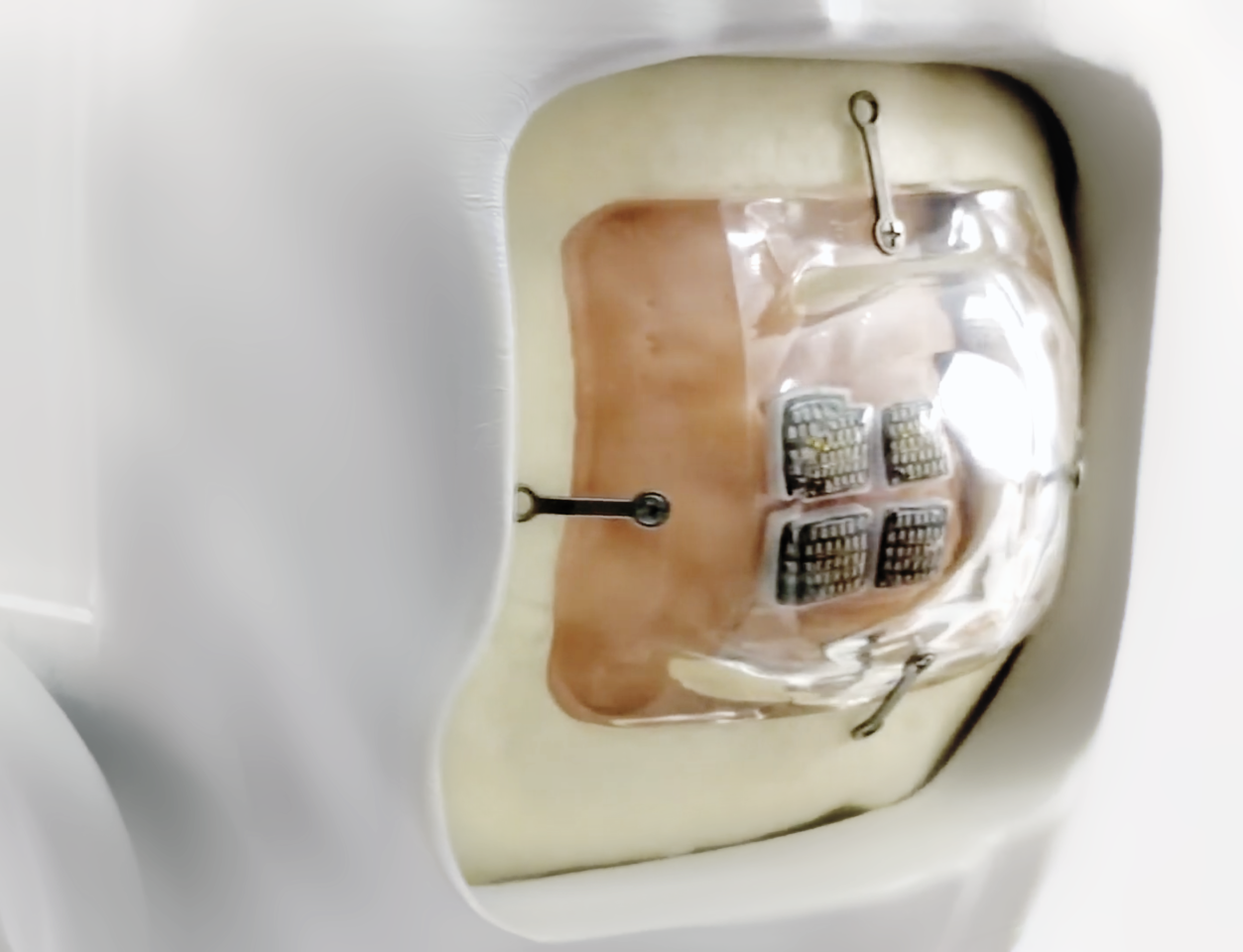 World's First Cortical Vision System Ready for Human Trials
