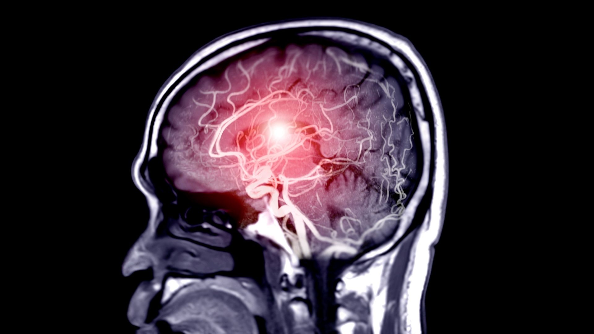 Scientists used magnetic resonance imaging to show brain inflammation ...