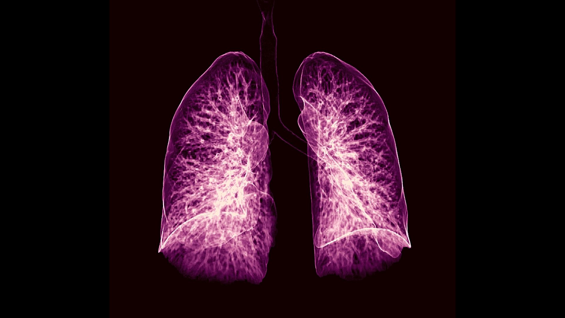 A New Artificial Intelligence Can Help Diagnose Lung Cancer a Year Early