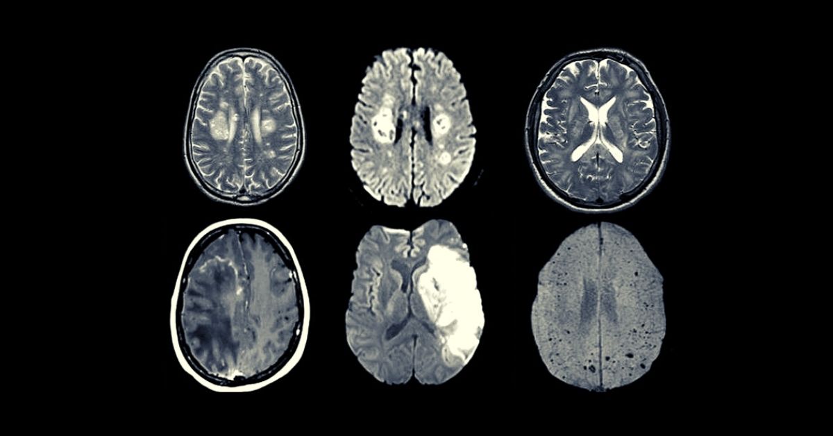 Coronavirus Can Infect, Hijack Brain Cells, Choke Nearby Neurons of ...
