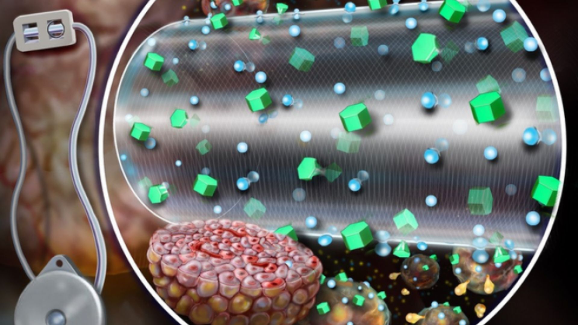 A Bioartificial Pancreas Could Substantially Enhance Type-1 Diabetes ...