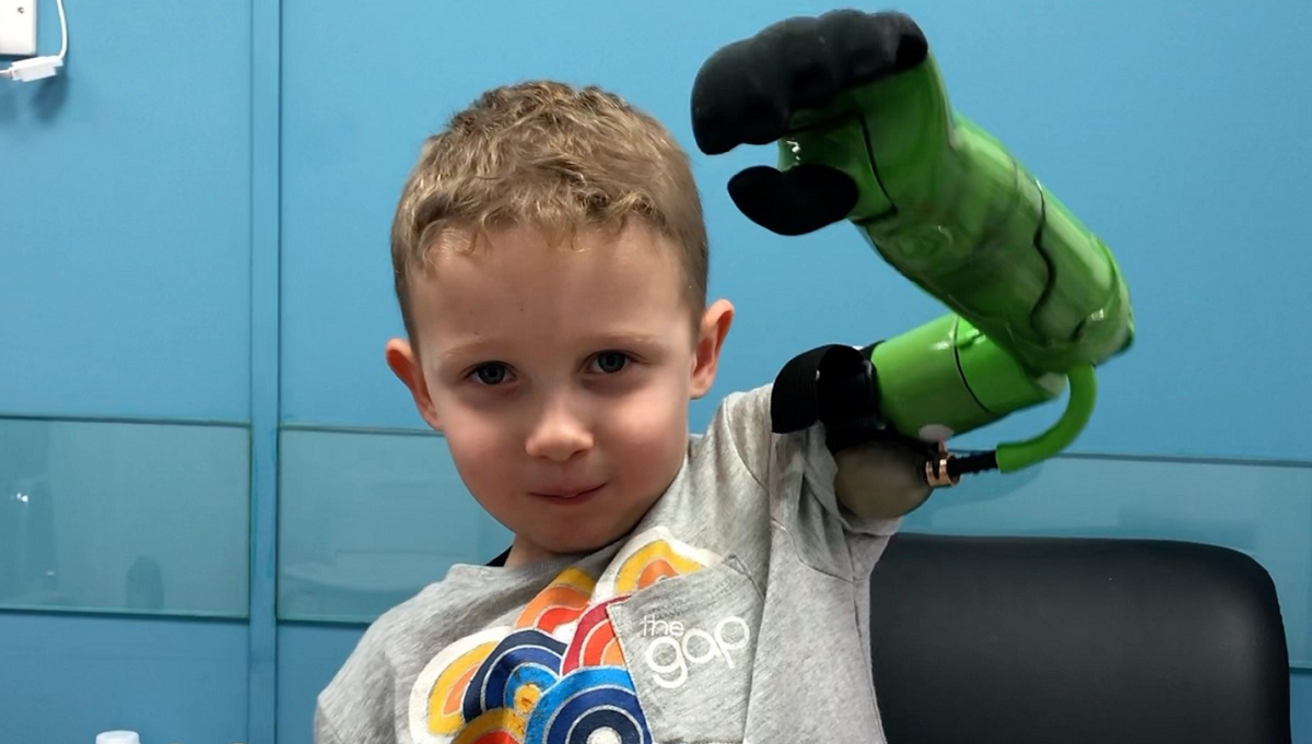 UK Boy First to Receive a Prosthetic Arm Above the Elbow