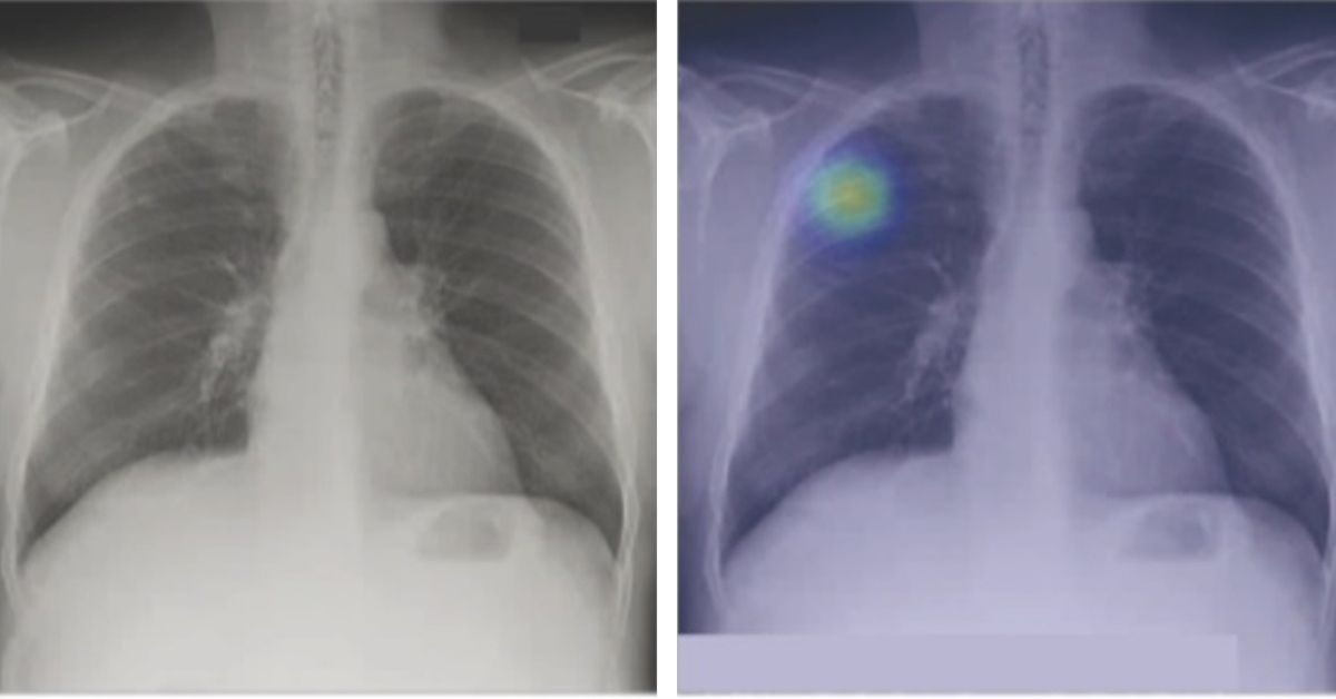 New Lung Cancer-Detecting AI Algorithm Shows Impressive Results