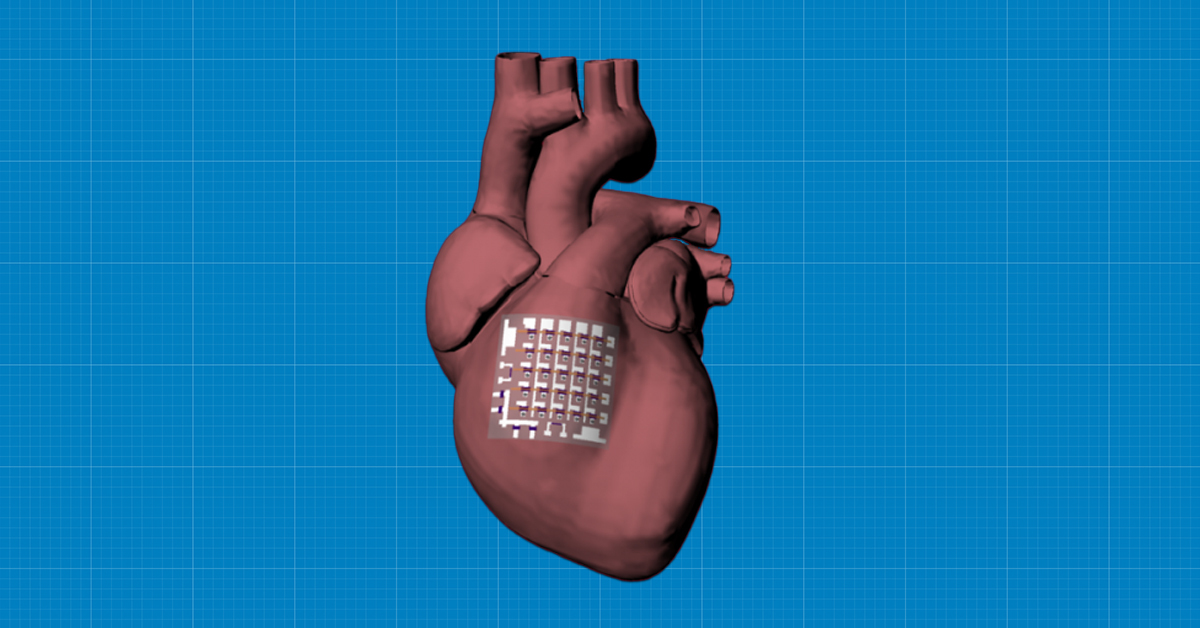 Bioelectronic Implantable Device Monitors, Treats Heart Disease