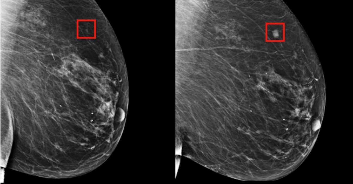Deep Learning Model Can Predict Breast Cancer up to Five Years in Advance