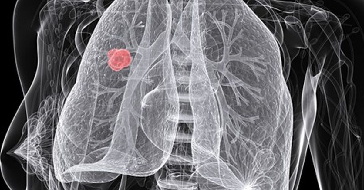 New Study Finds Many Deadly Cancers Attract the Least Amount of Funding