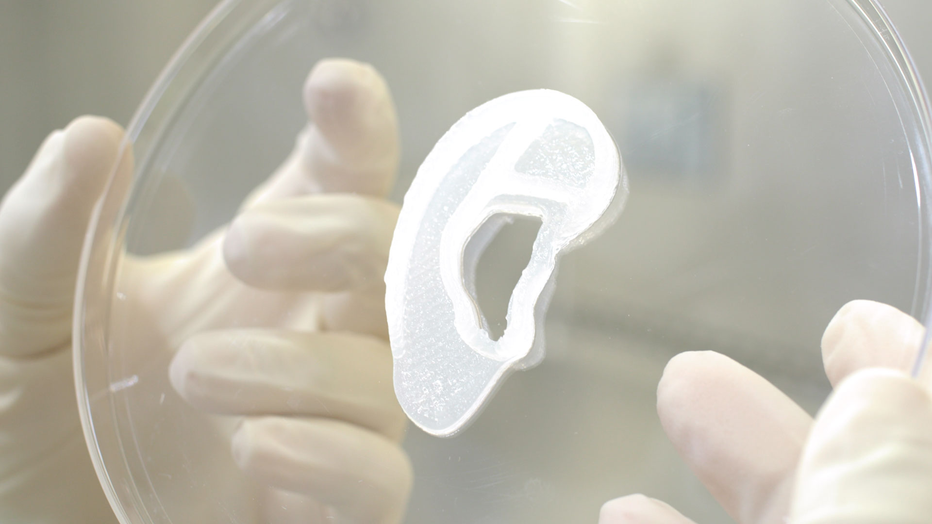 A 3D printed human ear has been successfully transplanted in a world-first