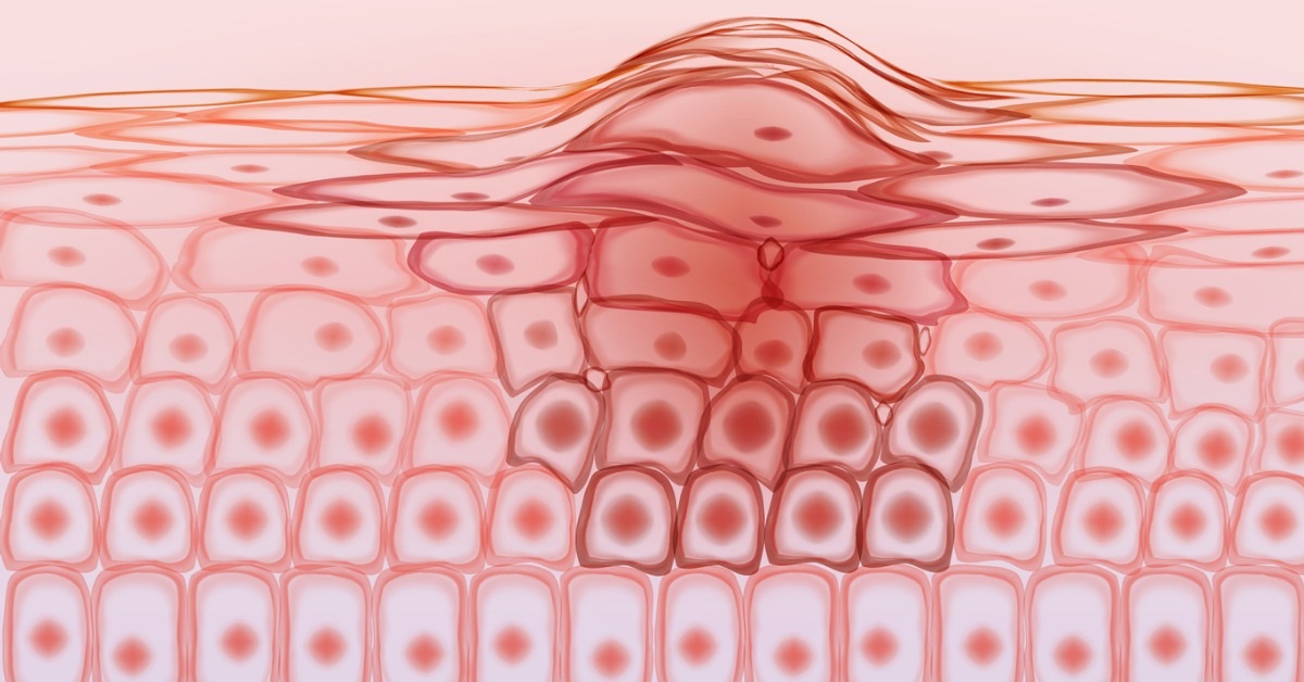 A New Pain-free Skin Patch Treatment Could Be Used to Fight Cancer