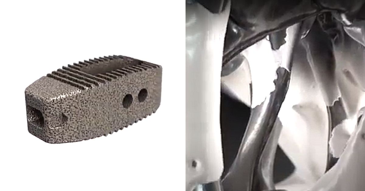 'Sponge-Like' Titanium Foam Spinal Implant Strengthens Local Bone In-Growth