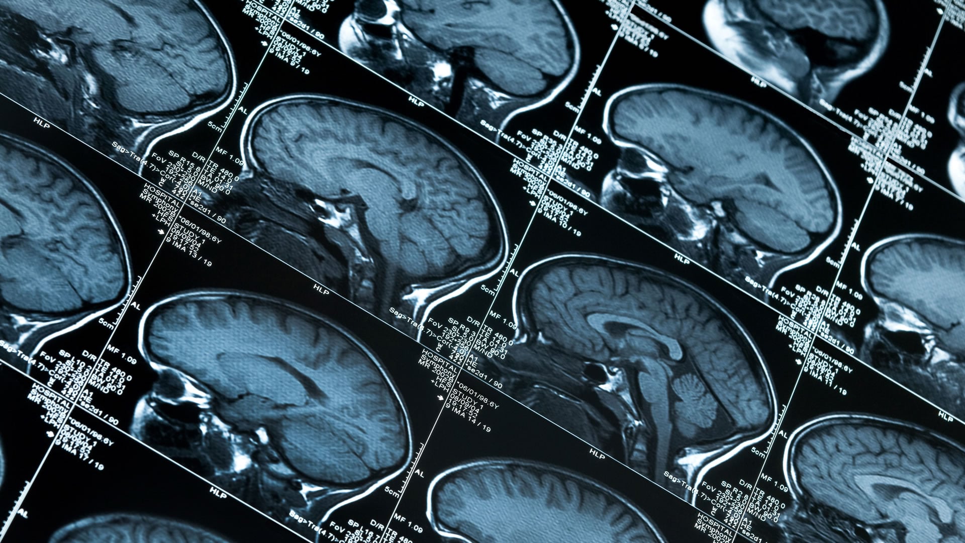 A new technique can detect Alzheimer's disease with just one MRI scan