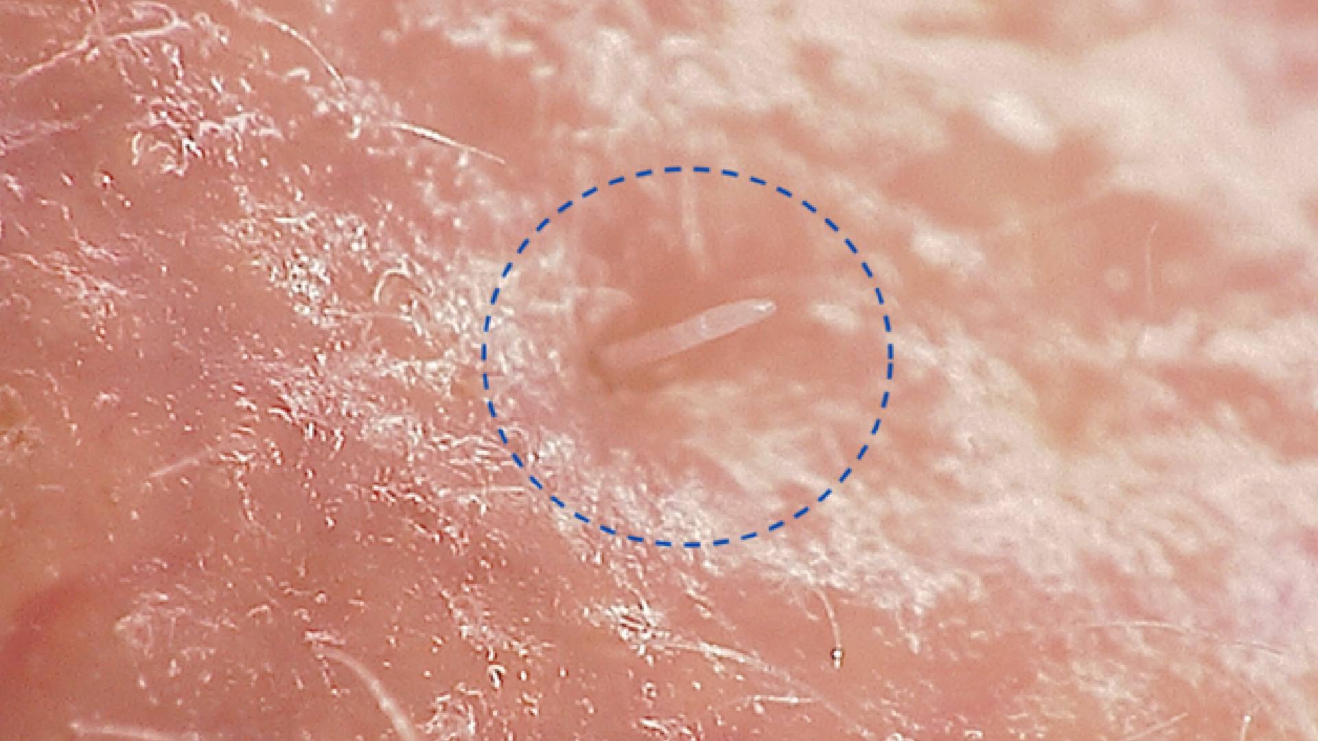 DNA reveals how mites are forming an evolutionary partnership with humans